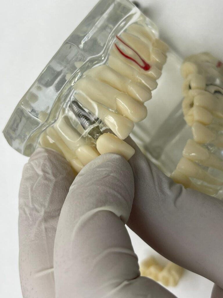 Implant Cast Model -Clear – orthofoxstore.com
