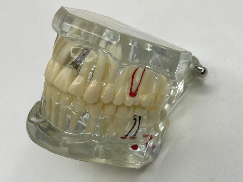 Implant Cast Model -Clear – orthofoxstore.com