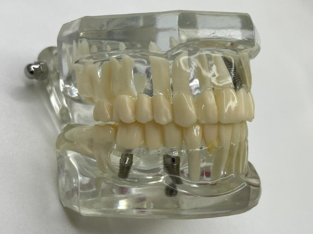 Implant Cast Model -Clear – orthofoxstore.com